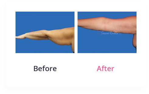 Arm Lift Before and After Photos | Dr. Semone Rochlin