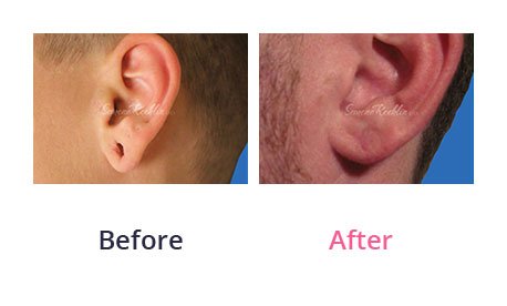 Earlobe Repair Before and After Photos | Dr. Semone Rochlin