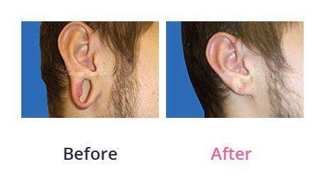 Earlobe Repair Before and After Photos | Dr. Semone Rochlin