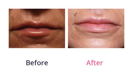 Lip Augmentation Before and After Photos | Dr. Semone Rochlin