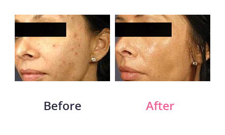 Chemical Peels Before and After Photos | Dr. Semone Rochlin