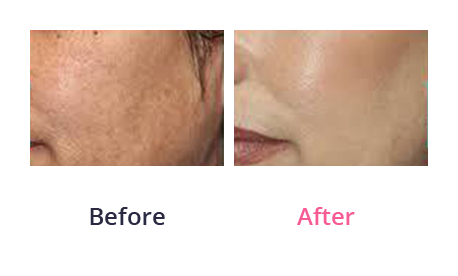 Chemical Peels Before and After Photos | Dr. Semone Rochlin