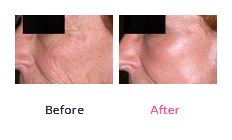 Chemical Peels Before and After Photos | Dr. Semone Rochlin